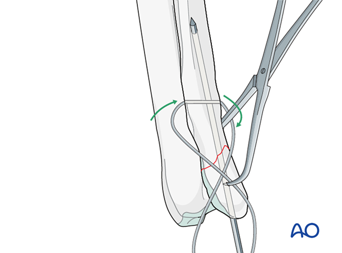 K-wire with or without tension band for Simple extraarticular fracture ...