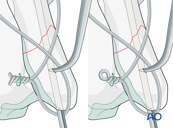 K-wire with or without tension band for Simple extraarticular fracture ...
