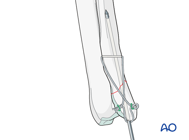K-wire with or without tension band for Simple extraarticular fracture ...
