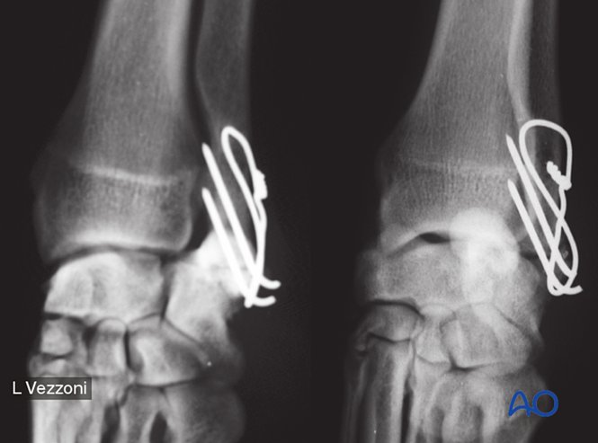 K-wire with or without tension band for Simple extraarticular fracture ...
