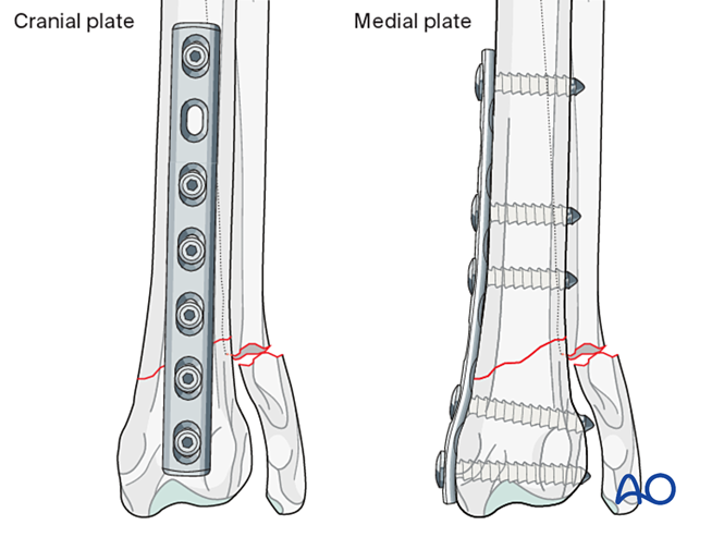 Compression plate fixation for Simple extraarticular fracture of the ...