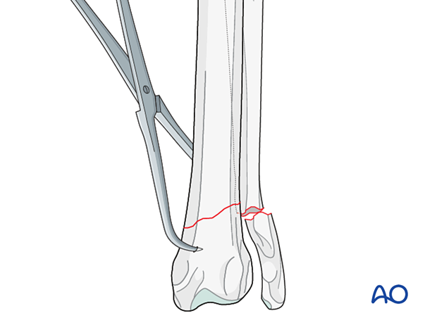 Compression plate fixation for Simple extraarticular fracture of the ...