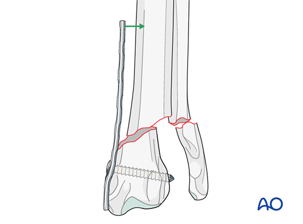 Compression plate fixation for Simple extraarticular fracture of the ...