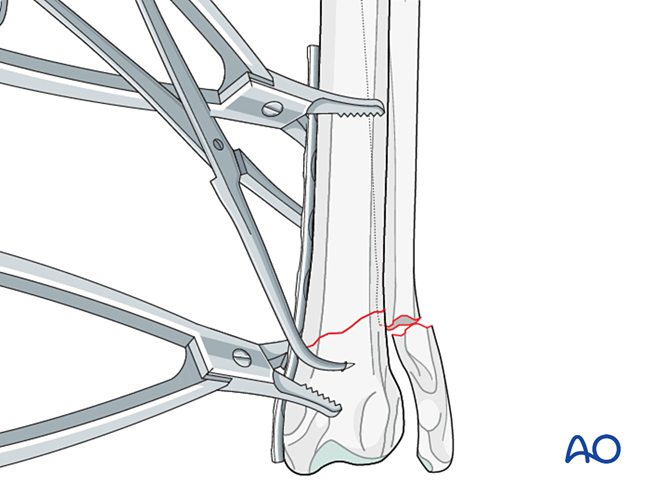 Compression plate fixation for Simple extraarticular fracture of the ...