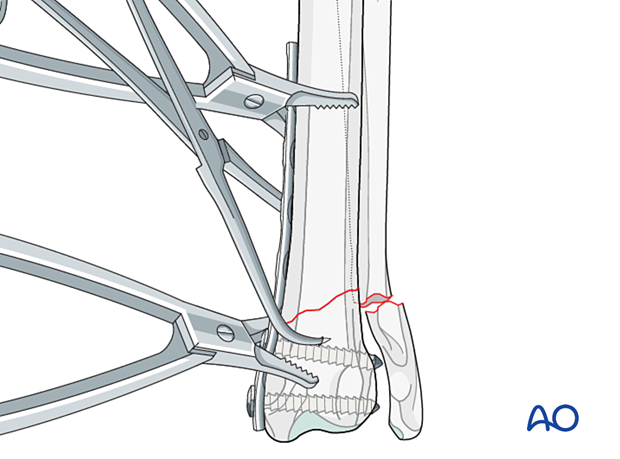 Compression plate fixation for Simple extraarticular fracture of the ...