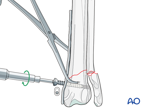Compression plate fixation for Simple extraarticular fracture of the ...