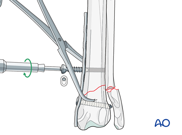 Compression plate fixation for Simple extraarticular fracture of the ...