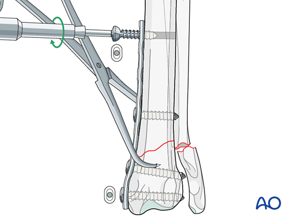 Compression plate fixation for Simple extraarticular fracture of the ...
