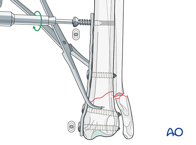 Compression plate fixation for Simple extraarticular fracture of the ...