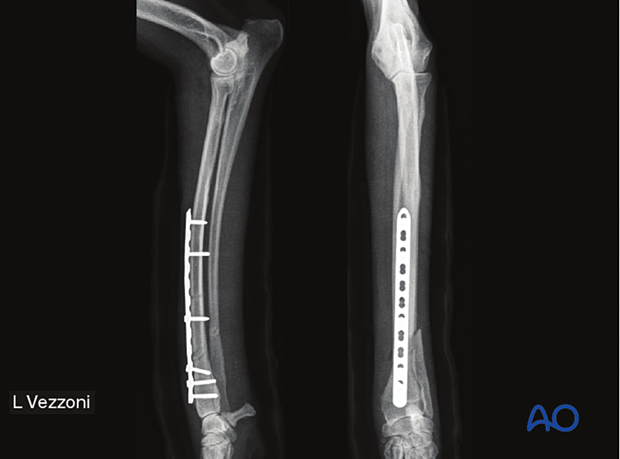 Compression plate fixation for Simple extraarticular fracture of the ...