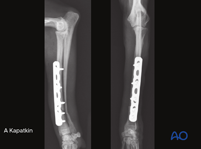 Compression plate fixation for Simple extraarticular fracture of the ...