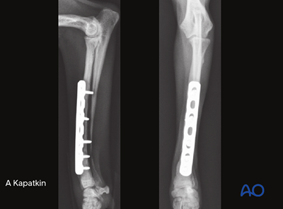 Compression plate fixation for Simple extraarticular fracture of the ...