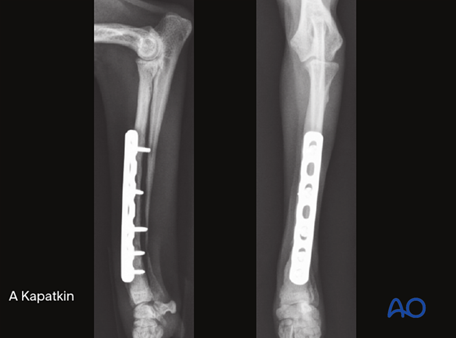 Compression plate fixation for Simple extraarticular fracture of the ...
