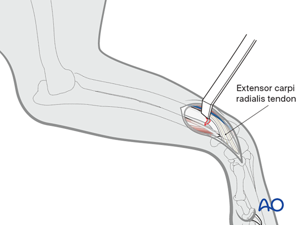 K-wire fixation for Simple extraarticular fracture of the distal radius