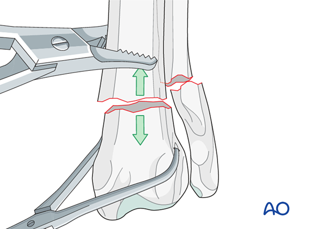 T-plate fixation for Simple extraarticular fracture of the distal radius