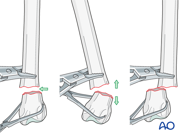 T-plate fixation for Simple extraarticular fracture of the distal radius