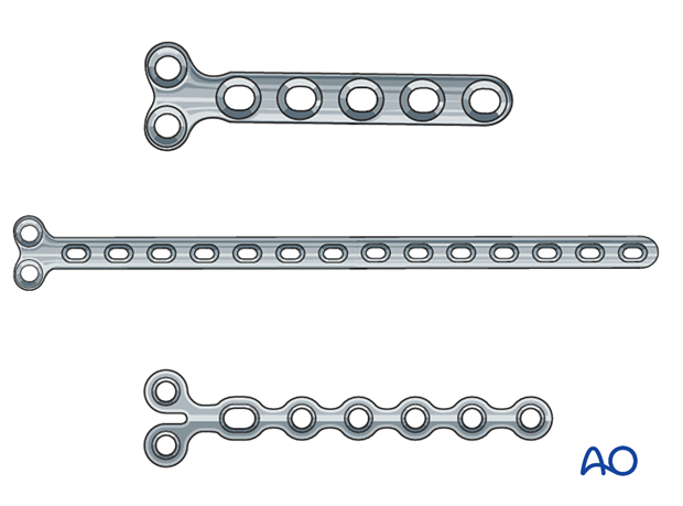T-plate fixation for Simple extraarticular fracture of the distal radius