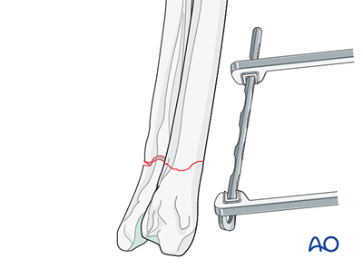 T-plate fixation for Simple extraarticular fracture of the distal radius
