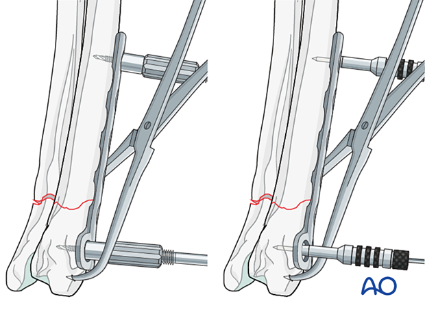 T-plate fixation for Simple extraarticular fracture of the distal radius