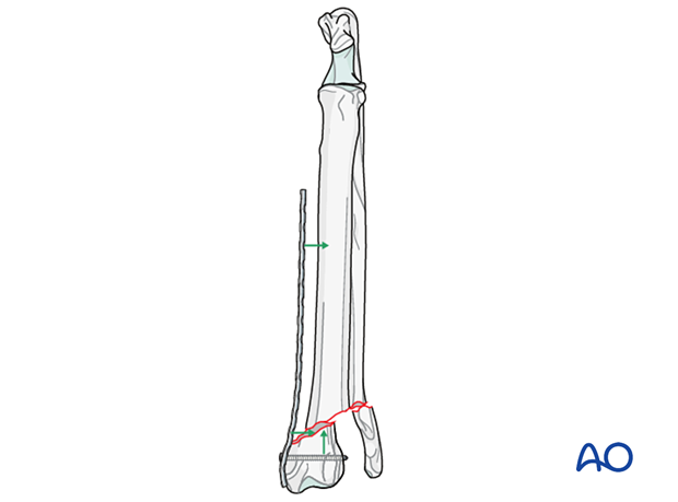 Bridging plate fixation for Simple extraarticular fracture of the ...