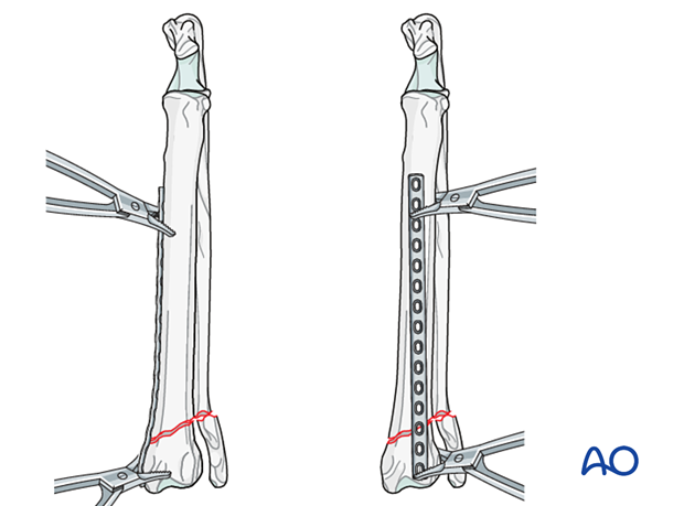 Bridging plate fixation for Simple extraarticular fracture of the ...