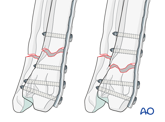 Bridging plate fixation for Simple extraarticular fracture of the ...