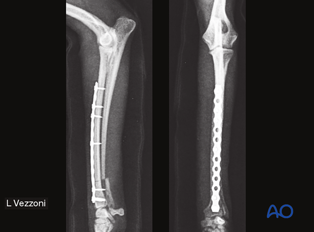 Bridging plate fixation for Simple extraarticular fracture of the ...