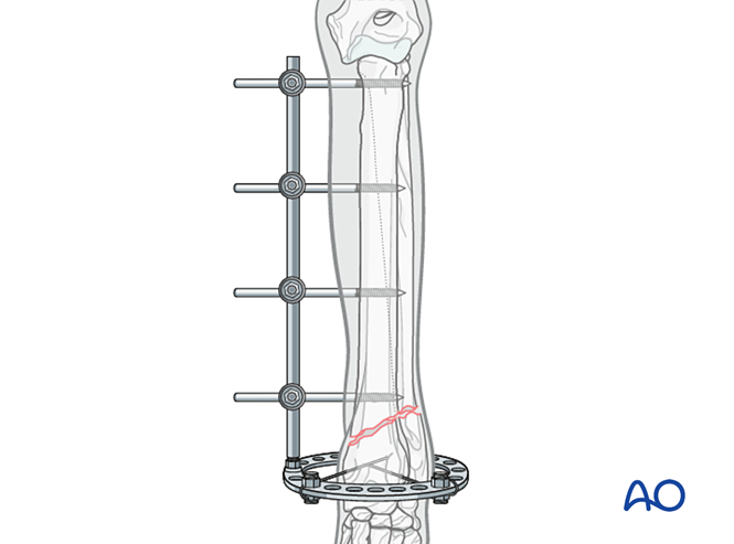 External skeletal fixation for Simple extraarticular fracture of the distal radius