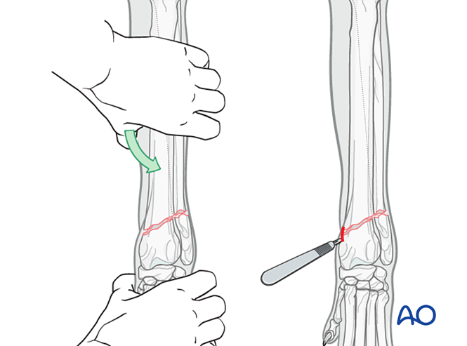 External skeletal fixation for Simple extraarticular fracture of the ...