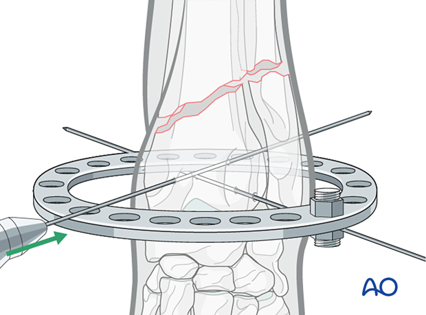 External skeletal fixation for Simple extraarticular fracture of the ...
