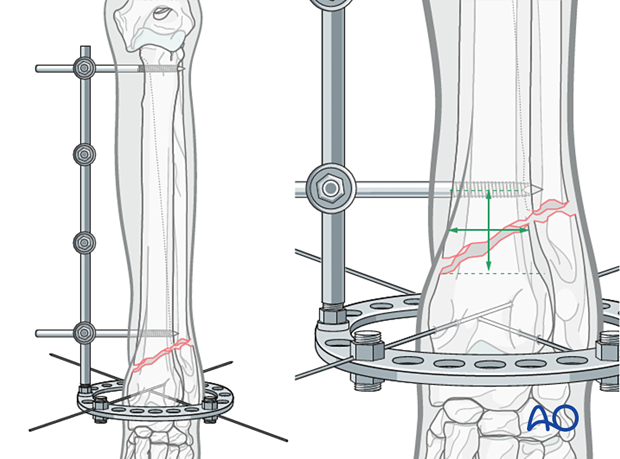 External skeletal fixation for Simple extraarticular fracture of the ...