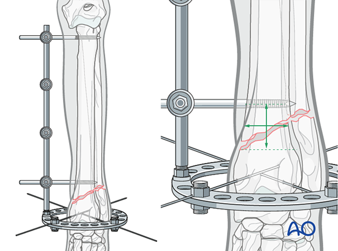External skeletal fixation for Simple extraarticular fracture of the ...