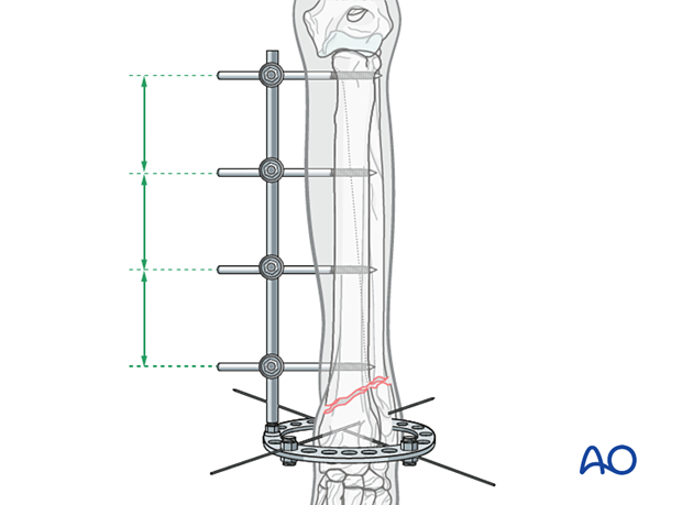 External skeletal fixation for Simple extraarticular fracture of the ...