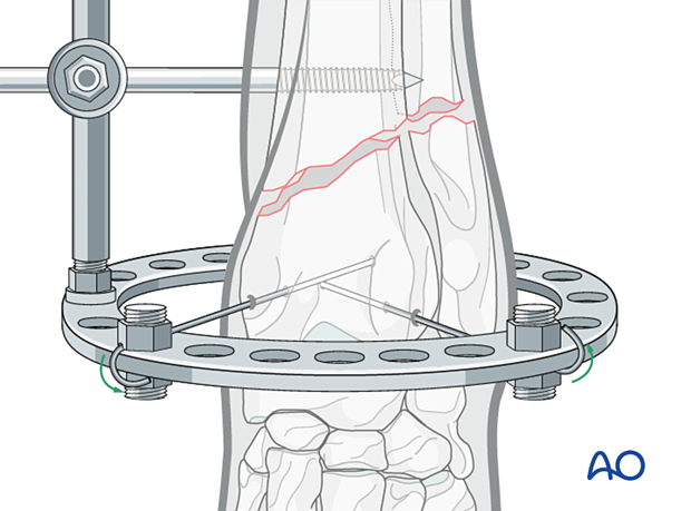 External skeletal fixation for Simple extraarticular fracture of the ...