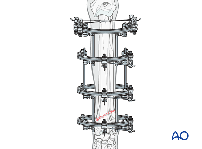 External skeletal fixation for Simple extraarticular fracture of the distal radius