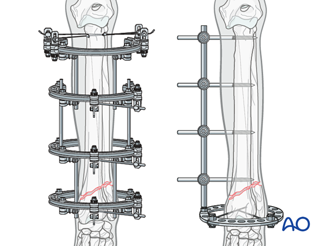 External skeletal fixation for Simple extraarticular fracture of the ...