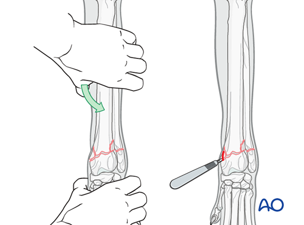External skeletal fixation for Multifragmentary extraarticular fracture ...