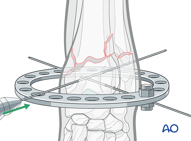 External skeletal fixation for Multifragmentary extraarticular fracture ...