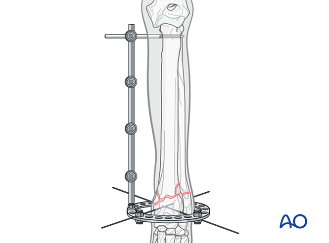 External skeletal fixation for Multifragmentary extraarticular fracture ...