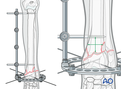 External skeletal fixation for Multifragmentary extraarticular fracture ...