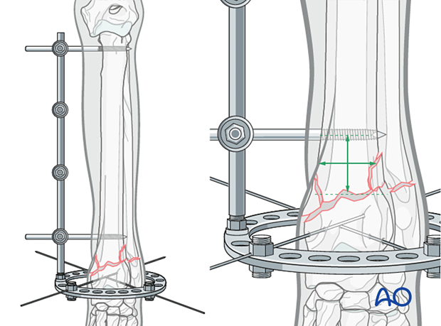 External skeletal fixation for Multifragmentary extraarticular fracture ...