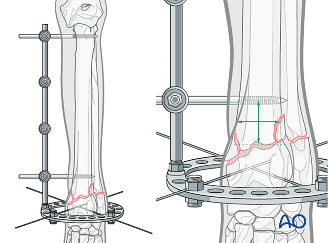 External skeletal fixation for Multifragmentary extraarticular fracture ...
