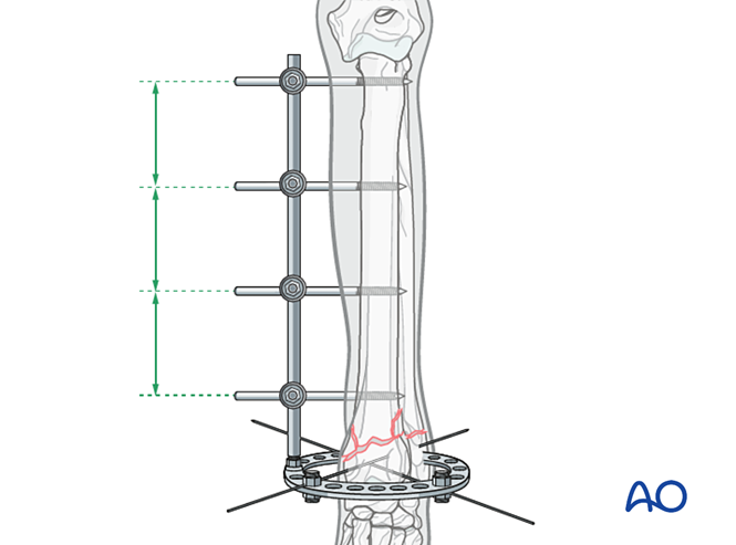 External skeletal fixation for Multifragmentary extraarticular fracture ...