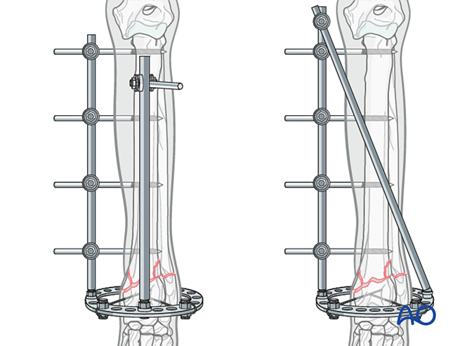 External skeletal fixation for Multifragmentary extraarticular fracture of the distal radius