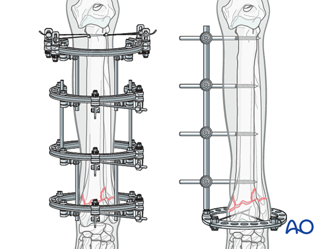 External skeletal fixation for Multifragmentary extraarticular fracture ...