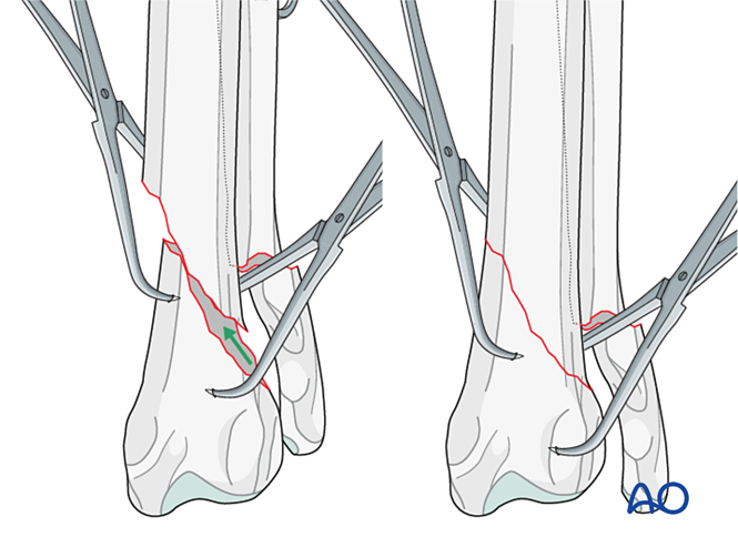 Lag screw and neutralization plate fixation for Simple extraarticular ...