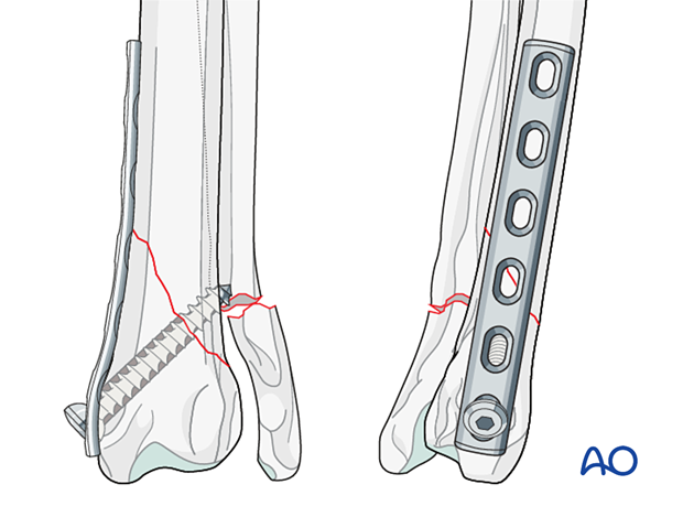 Lag screw and neutralization plate fixation for Simple extraarticular ...