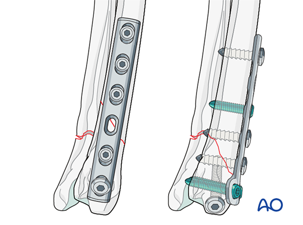 Lag screw and neutralization plate fixation for Simple extraarticular ...