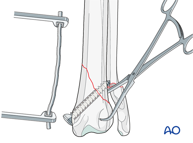 Lag screw and neutralization plate fixation for Simple extraarticular ...
