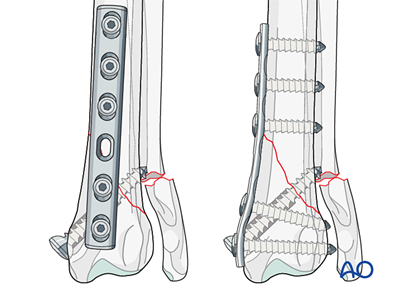 Lag screw and neutralization plate fixation for Simple extraarticular ...
